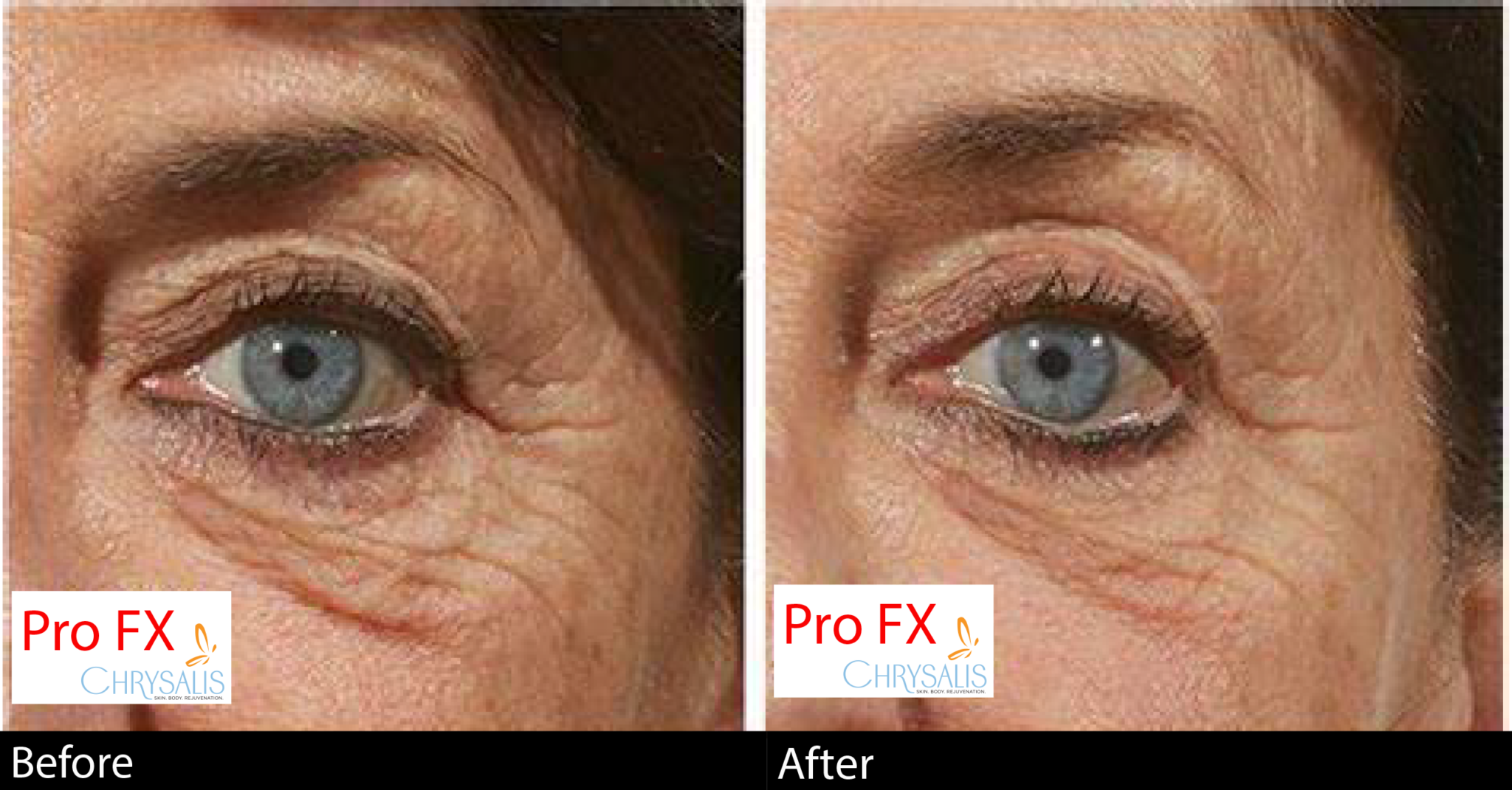 Pro FX Peel – Chrysalis