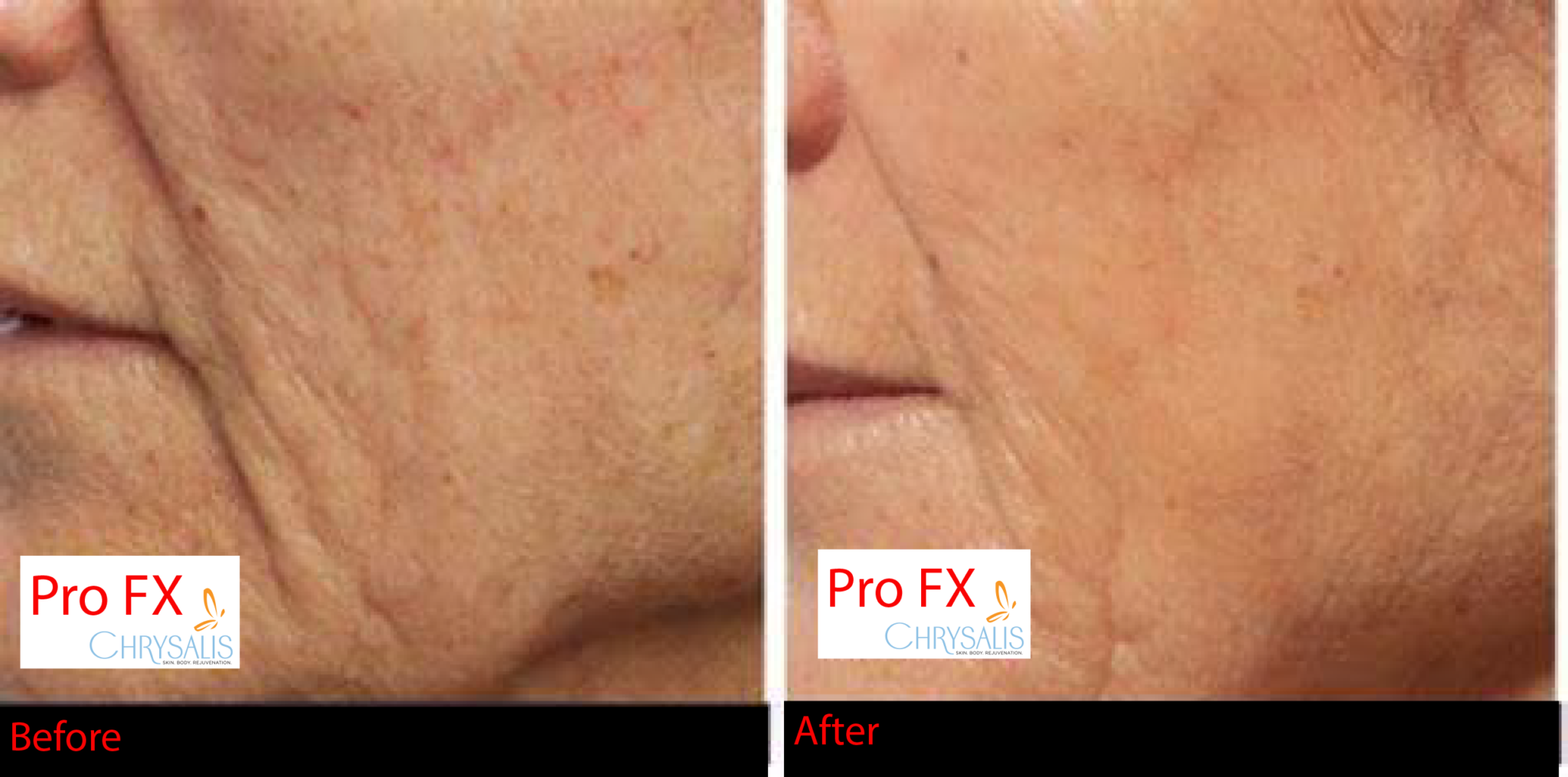 Pro FX Peel – Chrysalis